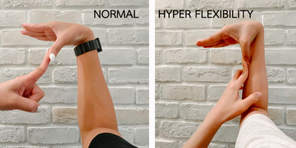 Hypermobile & Hyper flexibility | Le Physio Clinic